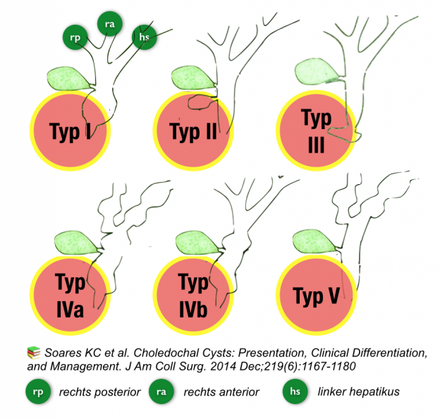 Choledochuszysten | Fortbildungsakademie der ÖGCH